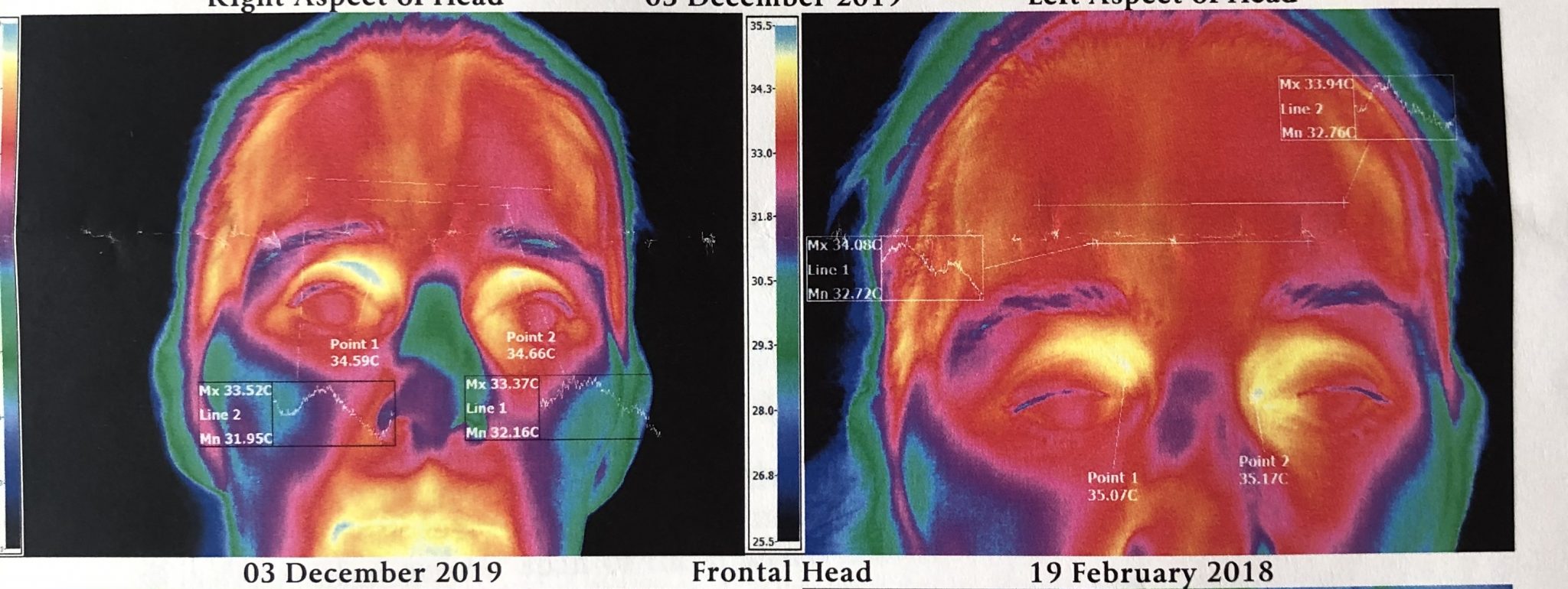 Therma-scan-.-frequencies- Overcoming Lyme Disease - Jennifer Heath ...